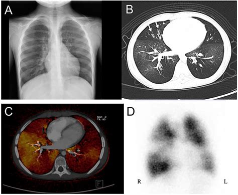 Normal Chest X Ray Vs Bronchitis