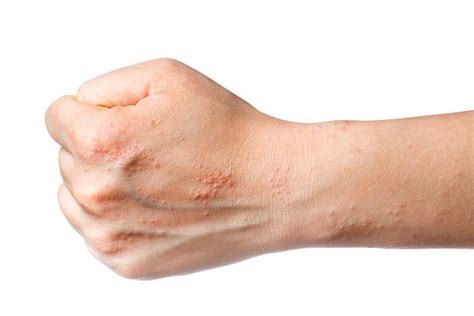 90 Eritroderma Foto Stok Potret And Gambar Bebas Royalti Istock