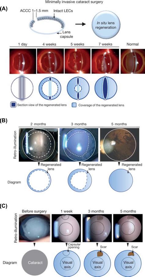 A Novel Minimally Invasive Surgical Technique For Promoting Lens