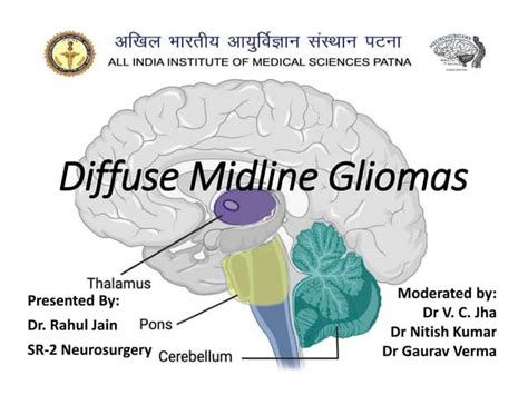 Brainstem Gliomas Diffuse Midline Gliomas Diffuse Pontine Gliomaspptx