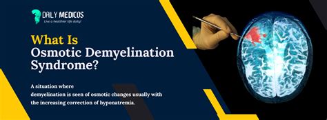 Osmotic Demyelination Syndrome All You Need To Know Daily Medicos