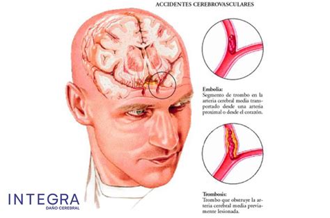 Ictus Cordis O Que é Librain