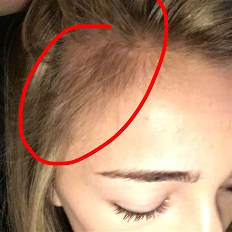 Bald Spots At 17 Thyroid Is Fine And I Have This On Both Sides Of My Head Any Ideas As To Why