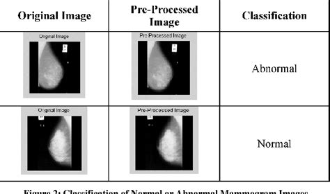 Abnormal Mammogram