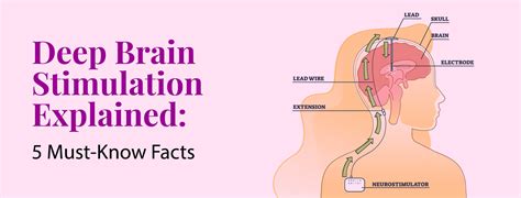 Deep Brain Stimulation Explained 5 Must Know Facts
