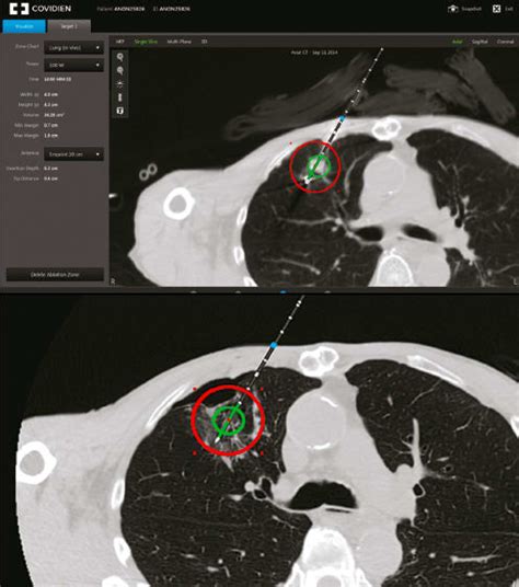 Advancing Ablation Technology Using Simulation Science Medical Design Briefs