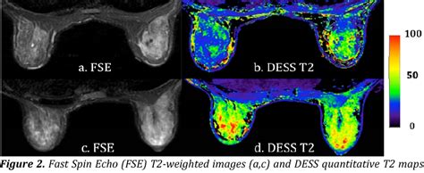 Figure 1 From Dual Echo Steady State Quantitative T 2 Mapping In The Breast Semantic Scholar