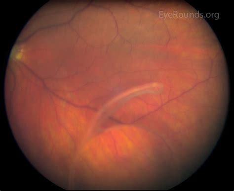 Displaced Intraocular Lens