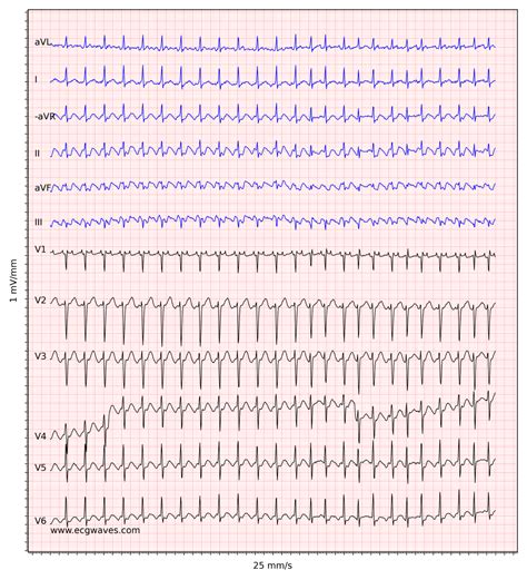 Atrial Flutter Classification Causes Ecg Diagnosis And Management