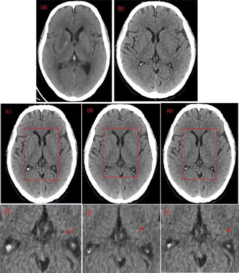 Registration Results Of A Typical Brain CT Image A Is The Reference