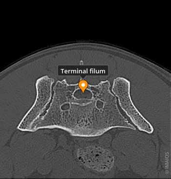 Anatomía Del Filum Terminal Anatomía Del Filum Terminal 1 02