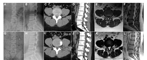 Figure 4 From Clinical Comparison Of Percutaneous Transforaminal