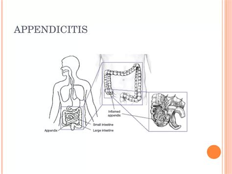 Appendicitis PPT