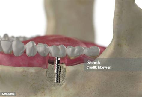 어금니 치아 치과 임플란트의 클로즈업 뷰 디테일 3d 렌더링 임플란트에 대한 스톡 사진 및 기타 이미지 임플란트 치아 임플란트 일러스트레이션 Istock