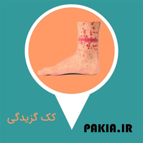 کک گزیدگی، شناسایی و راه‌های درمان کک گزیدگی