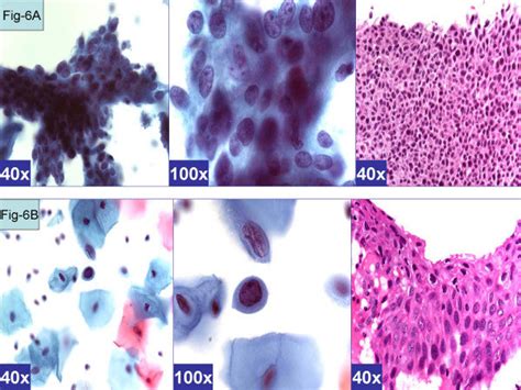 Hsil Pattern Asc H Favor Hsil A Syncytial Pattern Hyperchromatic
