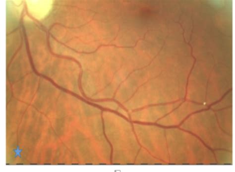 Artery Occlusion Flashcards Quizlet
