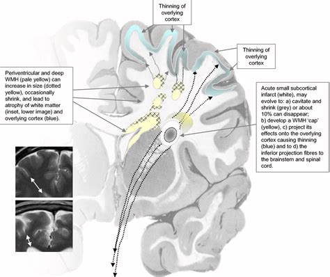 What Are White Matter Hyperintensities Made Of Journal Of The American Heart Association