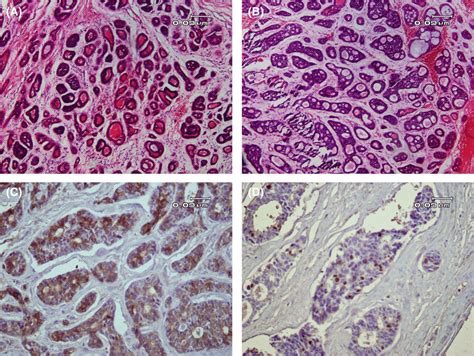 A Microscopic Examinations Show Tubular Pattern Of Small Basaloid Download Scientific Diagram