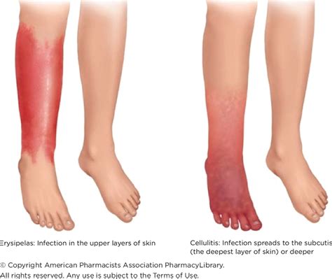 Erysipelas And Cellulitis Pharmacylibrary