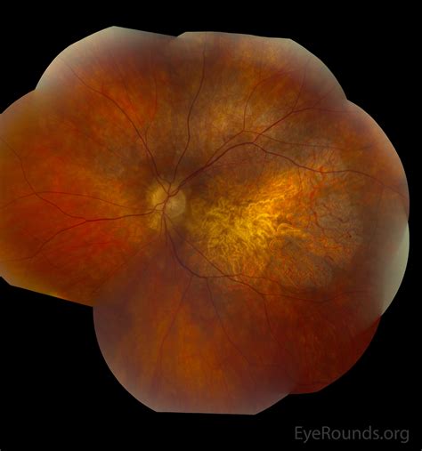 Atlas Entry Pattern Dystrophy Atlas Entry Pattern Dystrophy