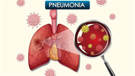 Causes Risk Symptoms And Prevention Of Pneumonia Onlymyhealth