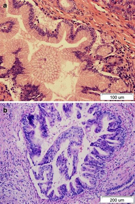 A B Panin In Patients With Eopcs A Panin 1b B Panin 3 Micropapillary