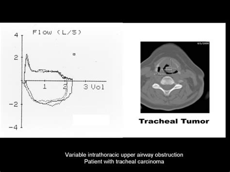 Disorders Of The Central Airways And Upper Airway Obstruction
