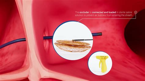 This Movie Is Showing In A General Way How An Occlutech Asd Occluder Is Implanted Youtube