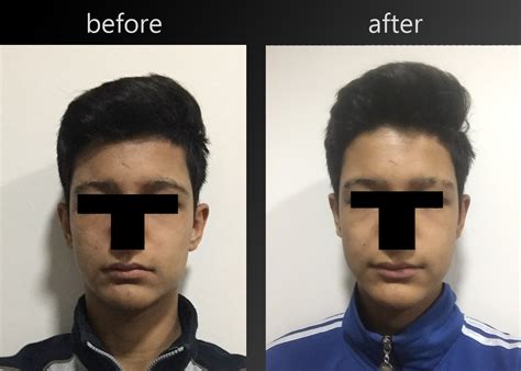 Banda Azelaic Acid One Month Difference Rskincareaddiction