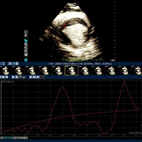 Myocardial Contrast Echocardiography After Injecting The Microbubble Download Scientific