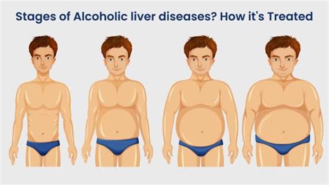 Stages Of Alcoholic Liver Diseases How Its Treated Dr Vikrant Kale