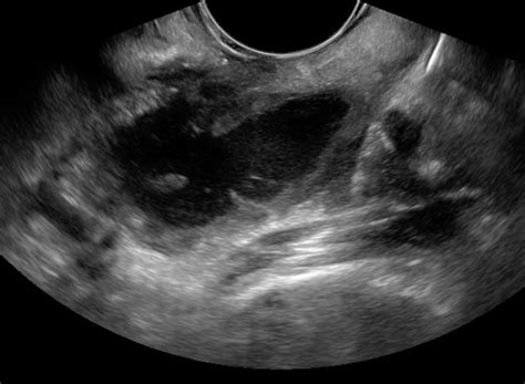 Bedside Ultrasound For The Diagnosis Of Peritonsillar Abscess Jetem