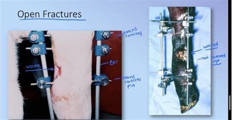 Lecture 2 Principles Of External Skeletal Fixation Flashcards Quizlet