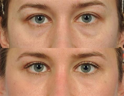 Tear Trough Filler Before And After Photos W Cosmetic Surgery