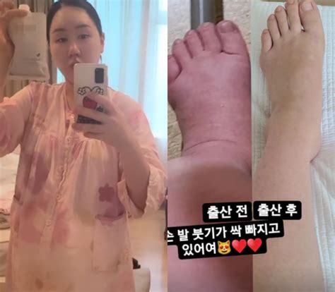 황신영 104kg 코끼리 발 탈출 세쌍둥이 출산 후 부기 싹 빠져