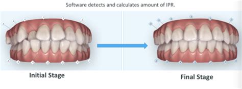 Invisalign 3 Performing Ipr Flashcards Quizlet
