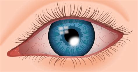 Stages Of Corneal Ulcer