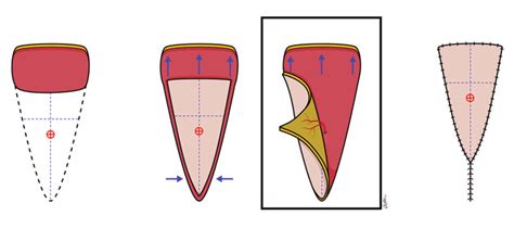 V Y Advancement Flap