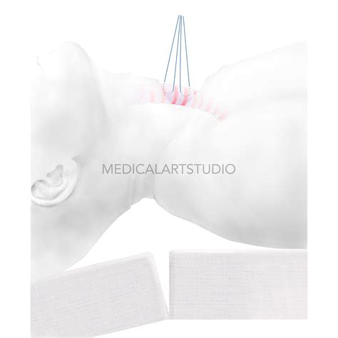 Trachea Surgery On Behance