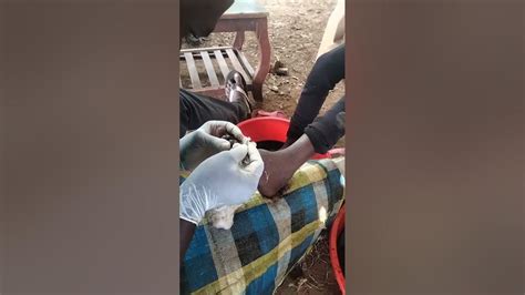 Removal Of Jiggers Youtube