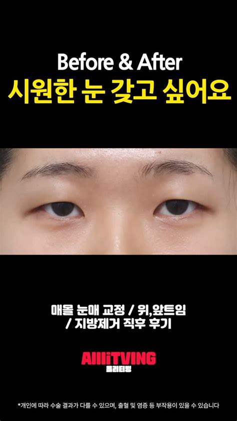 올리팅성형외과 찾았다 나의 두 번째 피부 어머니 올리팅성형외과 윤소현 원장님💕 Instagram