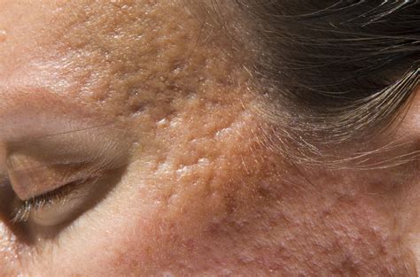 Aggressive Early Treatment May Prevent Acne Scars