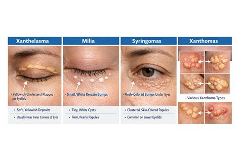 Xanthelasma Vs Milia Syringoma And Xanthomas Guide 2026