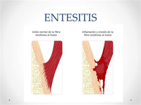 La Entesitis Centro Fisioterapia Segovia Sensocentro Fisioterapia