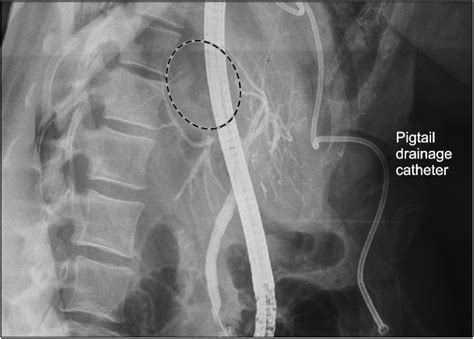 Endoscopic Retrograde Cholangiography Depicting Normal Findings Apart