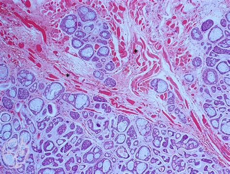 7 口腔唾液腺 7 唾液腺腫瘍腺様嚢胞癌 病理コア画像