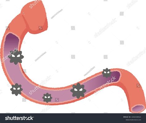 Duodenitis Condition Which Mucous Membrane Duodenum Stock Vector Royalty Free 2242228521