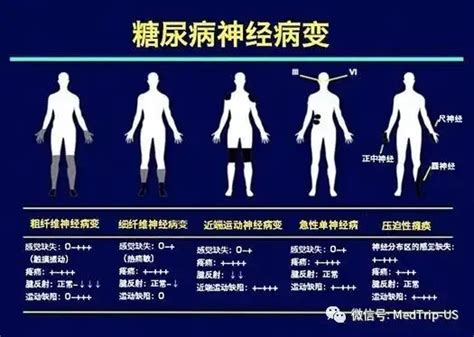 糖尿病神经病变（下） 知乎