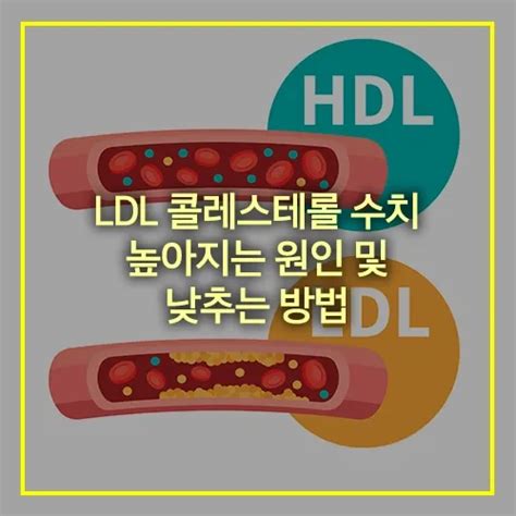Ldl 콜레스테롤 수치 높아지는 원인 및 낮추는 방법